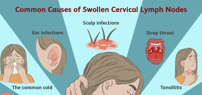 Swollen Lymph Nodes Symptoms & Impact in Fibromyalgia: Understanding ...