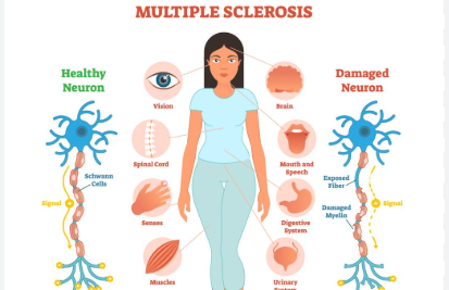 Fibromyalgia vs Multiple Sclerosis: Understanding the Key Differences ...
