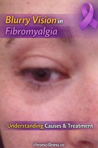 Blurry Vision in Fibromyalgia: Understanding Causes and Treatment
