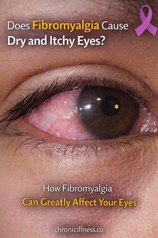 Does Fibromyalgia Cause Dry and Itchy Eyes? How Fibromyalgia Can ...