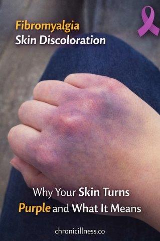 Fibromyalgia Skin Discoloration: Why Your Skin Turns Purple and What It ...