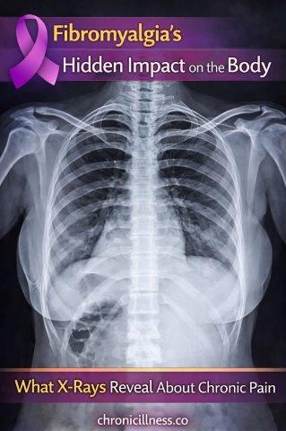 Fibromyalgia's Hidden Impact on the Body, What X-Rays Reveal About ...