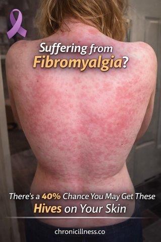 Suffering From Fibromyalgia? Understanding Hives and Skin Reactions