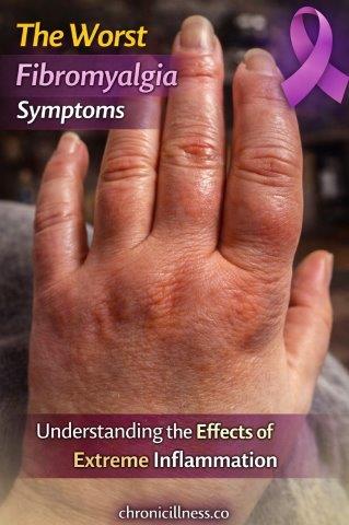 The Worst Fibromyalgia Symptoms: Understanding the Effects of Extreme ...