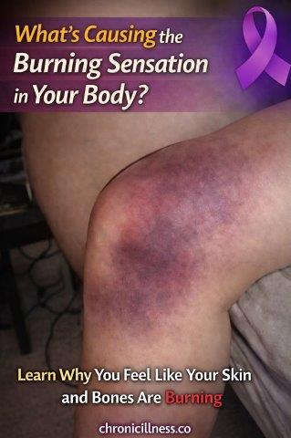 What’s Causing the Burning Sensation in Your Body? Understanding ...