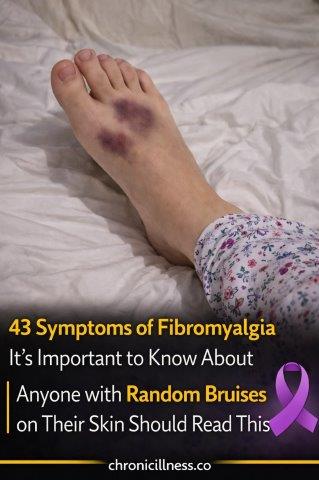 43 Symptoms of Fibromyalgia It’s Important to Know About: Why Anyone ...