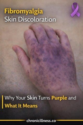 Fibromyalgia Skin Discoloration: Why Your Skin Turns Purple and What It ...