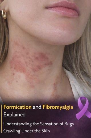 Formication and Fibromyalgia Explained: Understanding the Sensation of ...