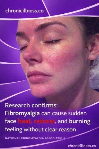 Fibromyalgia Face Flushing