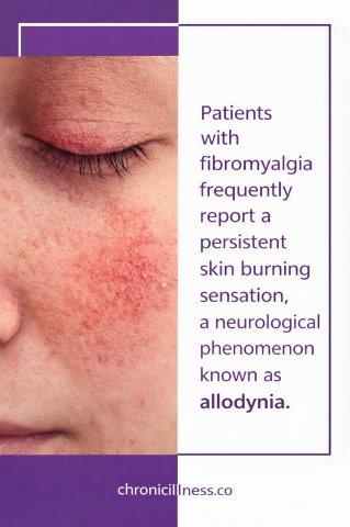 Fibromyalgia Skin Burning Allodynia