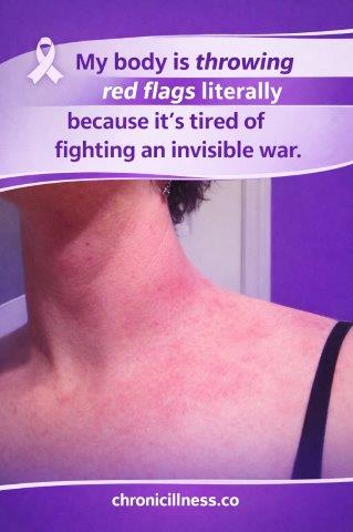 Fibromyalgia Skin Rashes