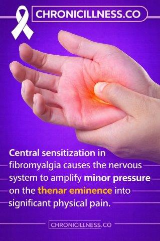 Fibromyalgia and Thenar Eminence Pain